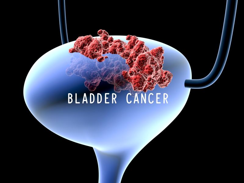 Bladder Cancer: Causes, Symptoms & Treatments | Doctors Without Waiting ...