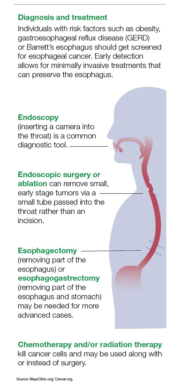 ESOPHAGEAL CANCER: SYMPTOMS & DIAGNOSIS | Doctors Without Waiting Rooms