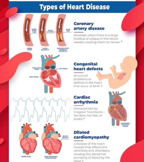 INFOGRAPHIC: TYPES AND CAUSES OF HEART DISEASE | Doctors Without ...
