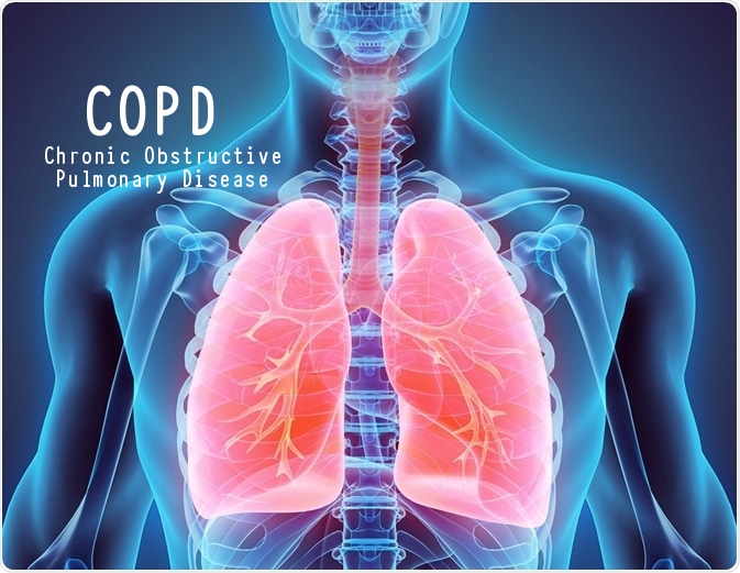 DR. C’S JOURNAL: COPD -CHRONIC OBSTRUCTIVE PULMONARY DISEASE | Doctors ...