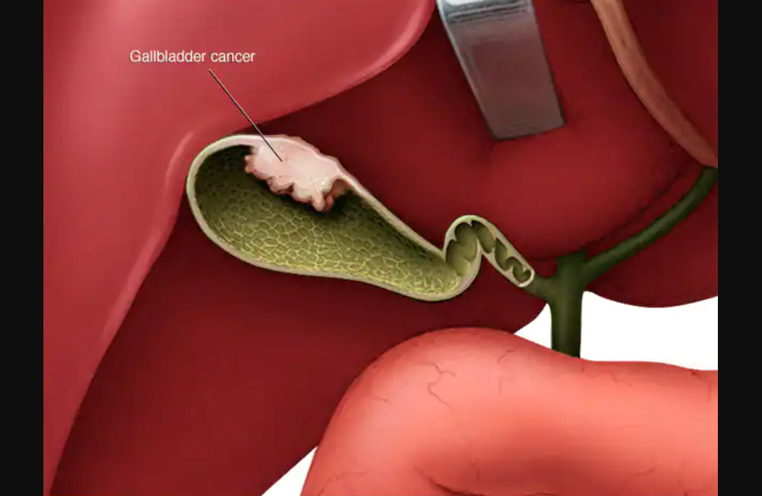 Mayo Clinic: Gallbladder Polyps & Cancer Diagnosis | Doctors Without ...