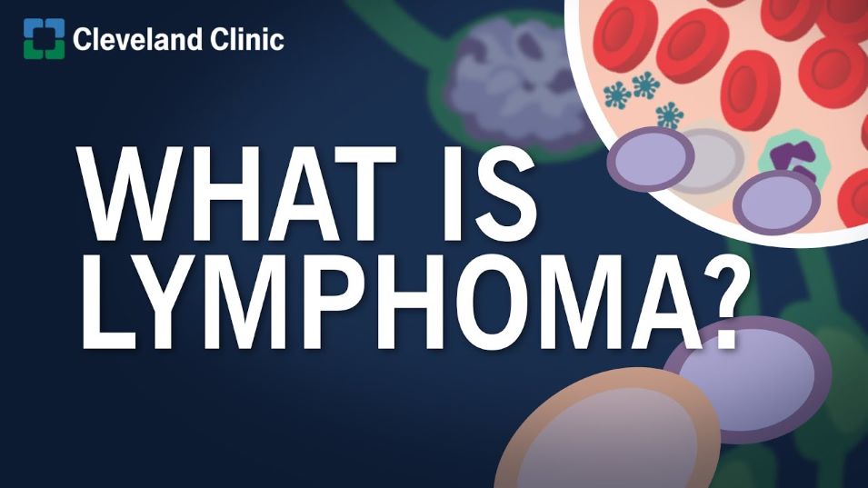 Lymphoma: Its Types And Causes (Cleveland Clinic) | Doctors Without ...