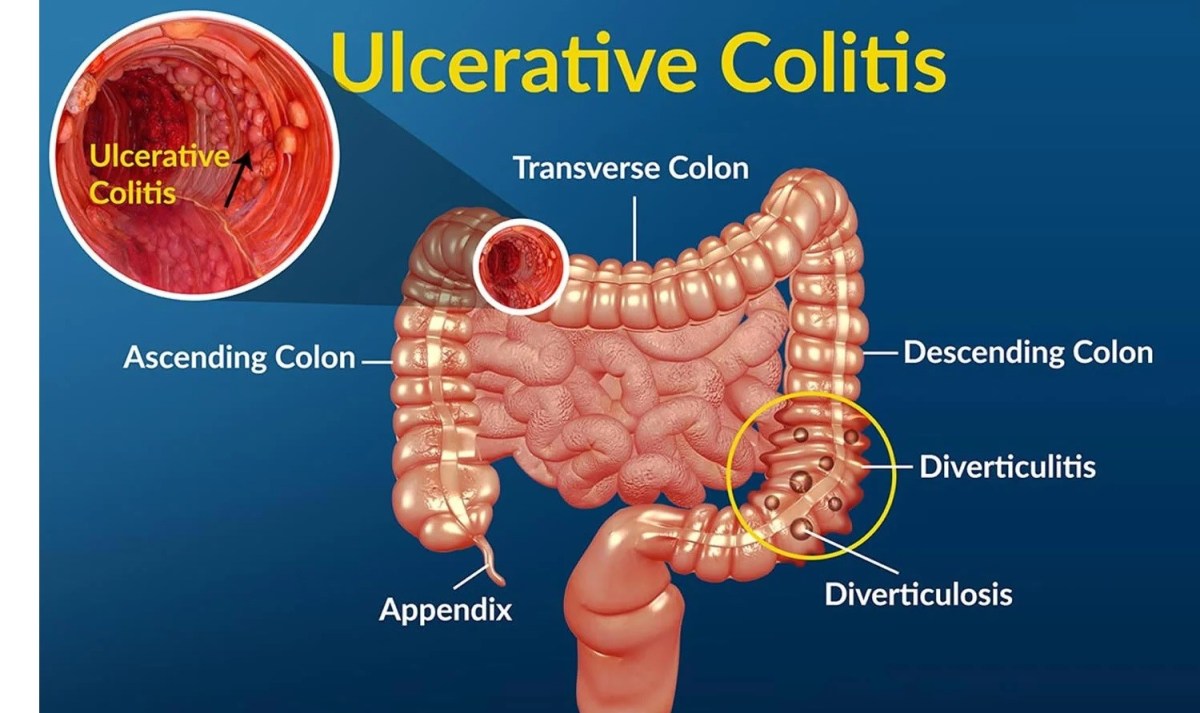 Inflammation: Treating Ulcerative Colitis (UC) | Doctors Without ...