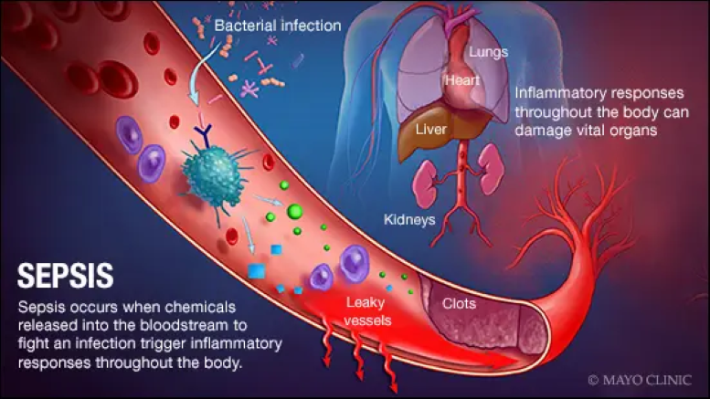 Medical Conditions: Signs And Treatment Of Sepsis | Doctors Without ...