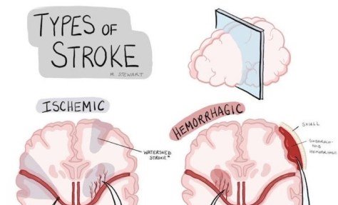 The Two Types Of Stroke: Ischemic & Hemorrhagic | Doctors Without ...