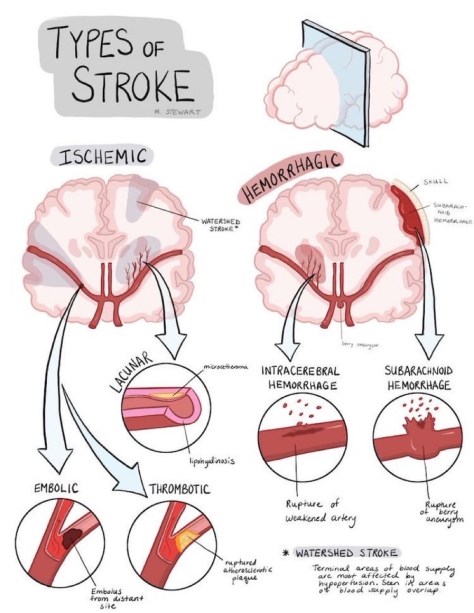 The Two Types Of Stroke: Ischemic & Hemorrhagic | Doctors Without ...