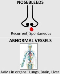 Dr. C’s Journal: What Is Hereditary Hemorrhagic Telangiectasia (HHT ...