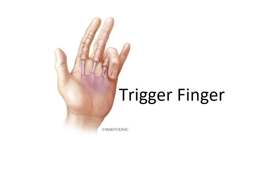Hand Conditions: What Causes Trigger Finger? | Doctors Without Waiting ...