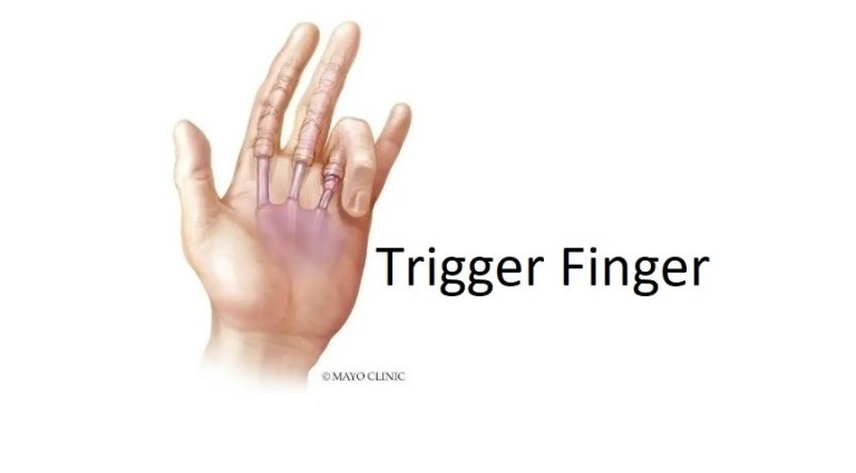 Hand Conditions: What Causes Trigger Finger? | Doctors Without Waiting ...