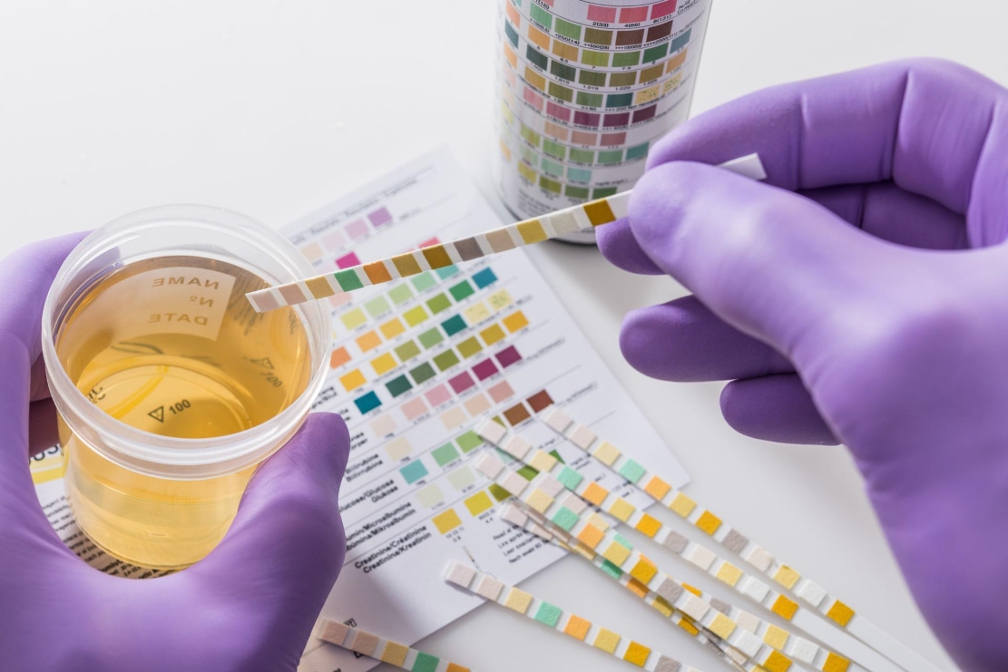 Screening Tests: What Makes Up A Urinalysis? | Doctors Without Waiting ...