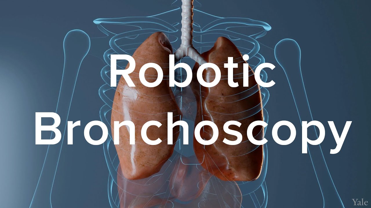 Lung Cancer: Benefits Of Robotic Bronchoscopy | Doctors Without Waiting ...