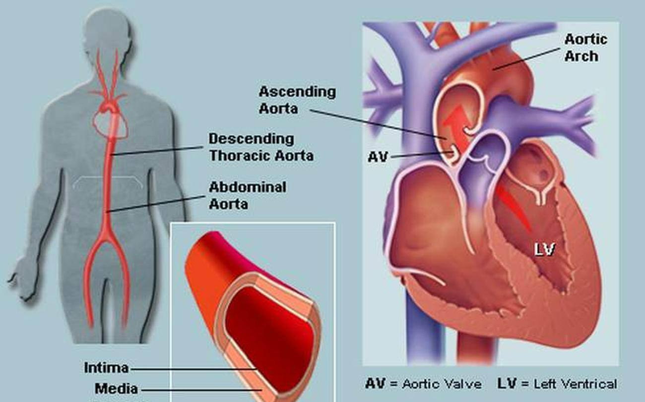 Heart Disease: A Surgeon’s View Of Aorta Surgery | Doctors Without ...
